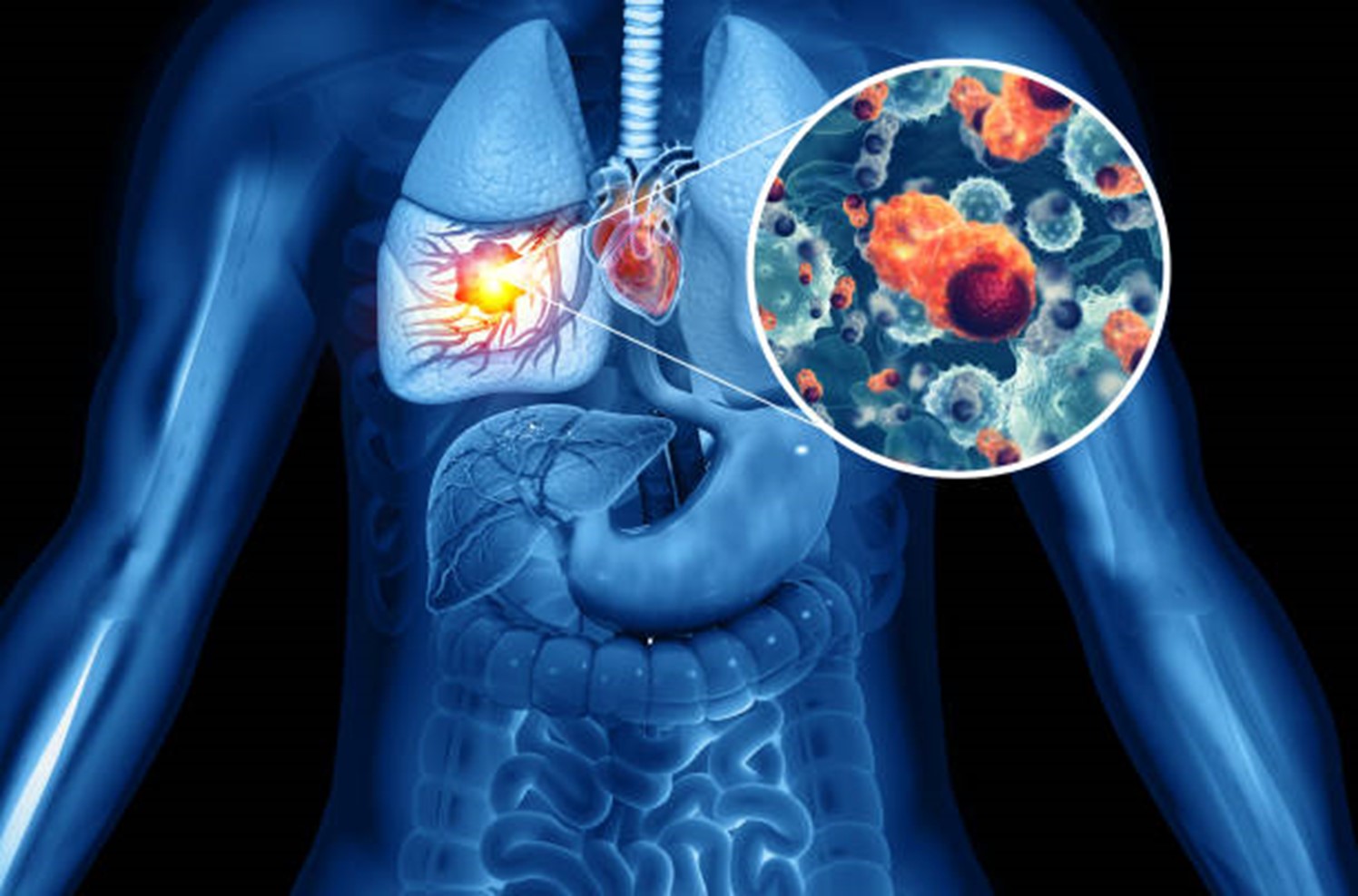 SBRT Radiation for Lung Cancer Treatment in India | Dr. Sridhar P S
